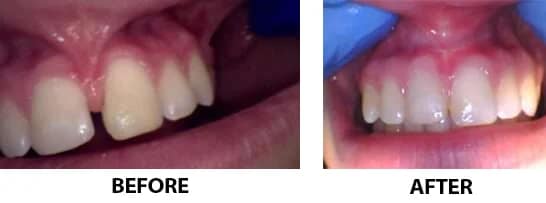Lip Ties