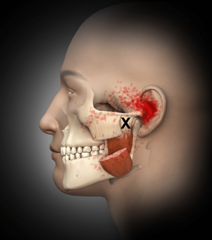 Oral Myofascial Pain: Symptoms, Diagnosis, and Treatment