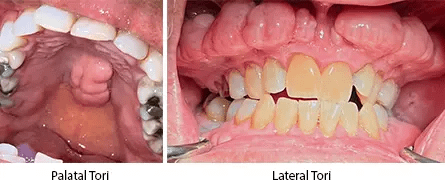 Laser Assisted Tori Removal
