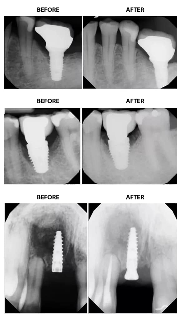 Dental Implant Repair