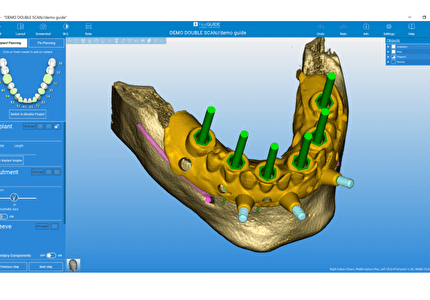 Enhancing Precision and Comfort in Dental Implant Surgery: The Power of ...