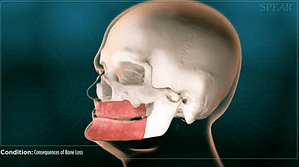Ridge Preservation (Bone Grafting) After Tooth Extraction: When is it ...