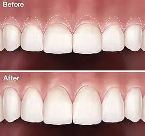 Gingivectomy and Aesthetic Crown Lengthening: Solutions for a Gummy Smile