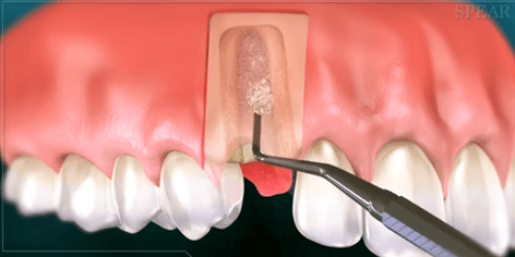 Ridge Preservation (Bone Grafting) After Tooth Extraction: When is it ...